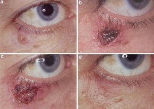 Treatment of basal cell carcinoma of the eyelids with 5% topical ...
