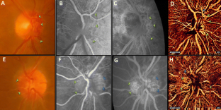 Morphological differences between optic disc collaterals and ...