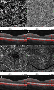 Characteristics of type 1 and 2 CNV in exudative AMD in OCT-Angiography ...
