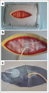 Classification, prevention and management of entero-atmospheric fistula ...