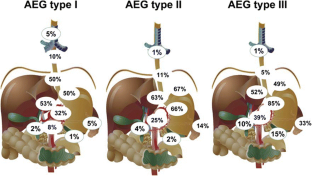Surgical approaches to adenocarcinoma of the gastroesophageal junction ...