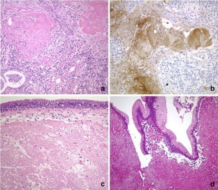 Ligneous conjunctivitis: a clinicopathological, immunohistochemical ...