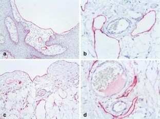 Pathogenesis of lymphangiomas | SpringerLink