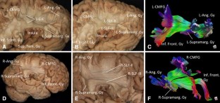 Subcomponents and connectivity of the superior longitudinal fasciculus ...