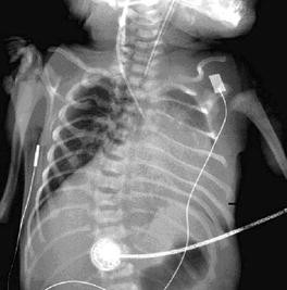 Congenital diaphragmatic eventration and bilateral uretero ...