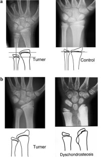 Wrist anomalies in Turner syndrome compared with Leri-Weill ...