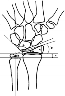 Wrist anomalies in Turner syndrome compared with Leri-Weill ...