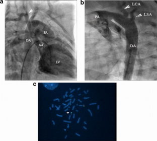 A rare association of interrupted aortic arch type C and microdeletion ...