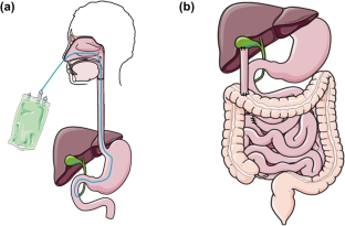 Nasobiliary drainage prior to surgical biliary diversion in progressive ...