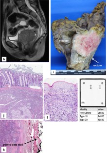 Invasive stratified mucin-producing carcinoma (i-SMILE) of the uterine ...
