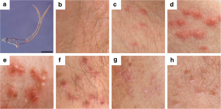 Cercarial dermatitis: a systematic follow-up study of human cases with ...