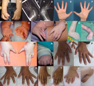 Clinical and mutation data in 12 patients with the clinical diagnosis ...