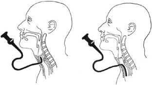 Effects of the Removal of the Tracheotomy Tube on Swallowing During the ...