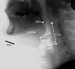 Swallowing Kinematics and Factors Associated with Laryngeal Penetration ...