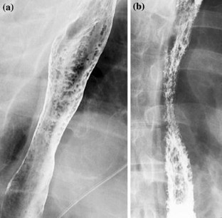 History and Evolution of the Barium Swallow for Evaluation of the ...