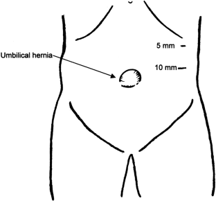 Umbilical hernia in adults | SpringerLink