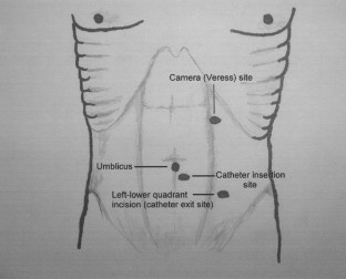 A new laparoscopic technique for the placement of a permanent ...