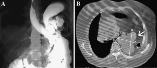 Laparoscopic repair of adult diaphragmatic hernias and eventration with ...