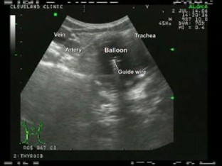 Percutaneous transesophageal gastrostomy (PTEG): a safe and effective ...