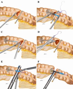 Totally laparoscopic sigmoid colectomy: a simple and safe technique for ...