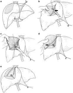 Segmentectomy of the liver | SpringerLink