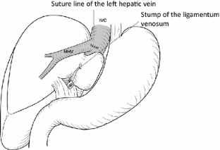 Left hepatectomy | SpringerLink