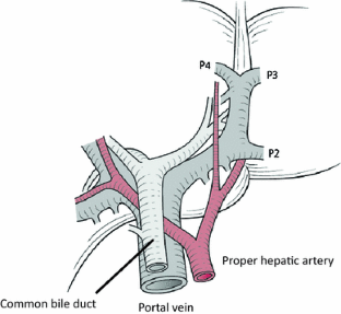 Left hepatectomy | SpringerLink