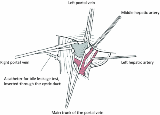 Left hepatectomy | SpringerLink