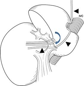 Left hepatectomy | SpringerLink