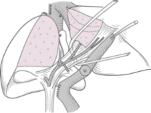 Right hepatectomy with resection of caudate lobe and extrahepatic bile duct for hilar ...