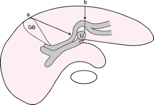 Right hepatectomy with resection of caudate lobe and extrahepatic bile ...