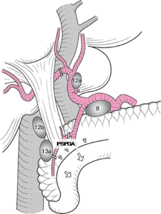 Right hepatectomy with resection of caudate lobe and extrahepatic bile ...