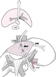 Right hepatectomy with resection of caudate lobe and extrahepatic bile duct for hilar ...