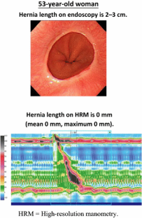 Endoscopic diagnosis of hiatus hernia under deep inspiration is not ...