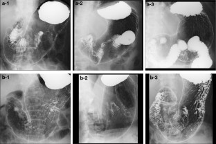 Detection of gastritis by a deep convolutional neural network from ...