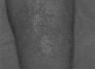 Lymphangiosarcoma in Congenital Familial Lymphedema (Milroy Disease ...