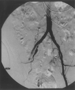 Peripheral Vascular Complication from Coronary Angiography: a Case ...