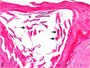 Pustular rumenitis associated with epithelial akeratosis, dyskeratosis ...