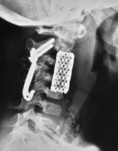 Titanium mesh cages (TMC) in spine surgery | SpringerLink