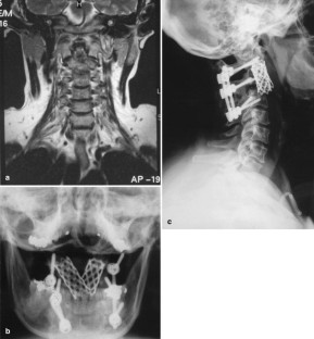 Titanium mesh cages (TMC) in spine surgery | SpringerLink