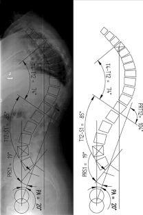 Lumbo-pelvic lordosis and the pelvic radius technique in the assessment ...