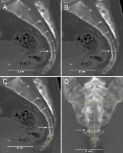 CT morphology and morphometry of the normal adult coccyx | SpringerLink