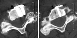 Zero-P: a new zero-profile cage-plate device for single and multilevel ...