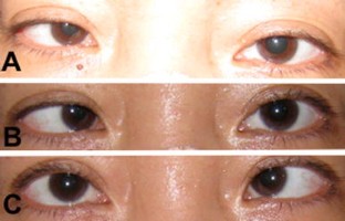 Bilateral abducens nerve palsy following ligamentous C1–C2 distraction ...