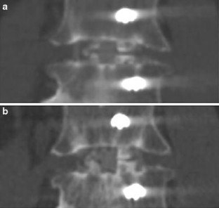 Comparing the process of creeping substitution between allograft bone ...