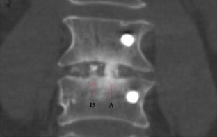 Comparing the process of creeping substitution between allograft bone ...