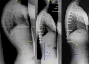 Distal junctional kyphosis in patients with Scheuermann’s disease: a ...