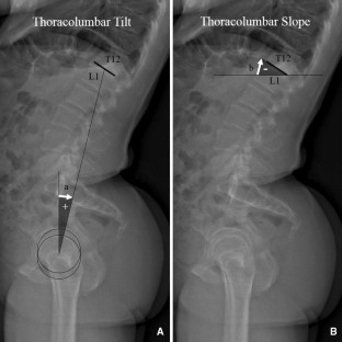 Thoracolumbar junction orientation: its impact on thoracic kyphosis and ...