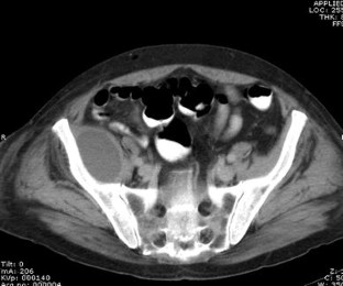 Iliacus abscess: an entity to be differentiated from psoas abscess: a ...