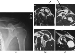 MRI evaluation of coracoclavicular ligament injury in acromioclavicular ...